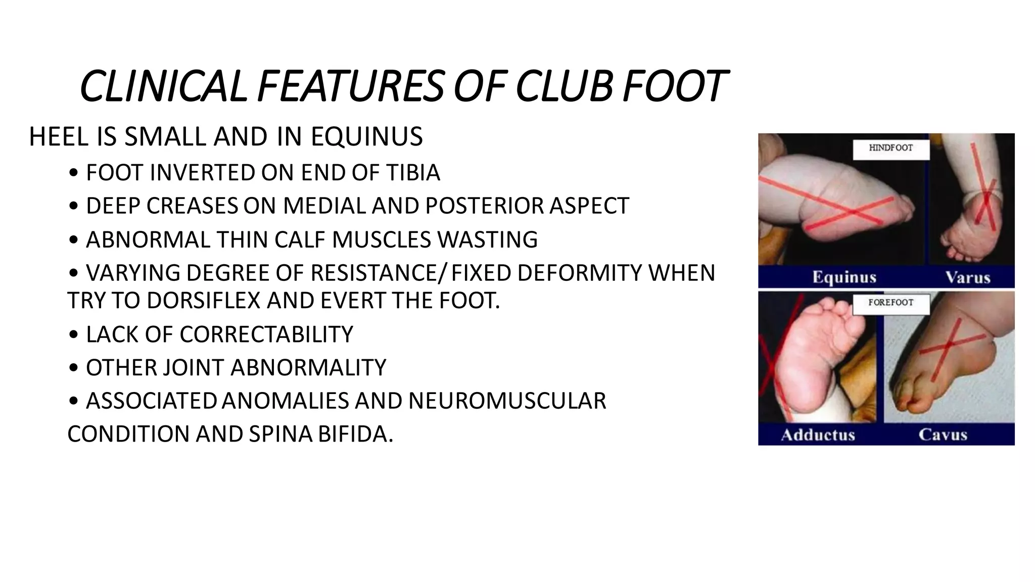 Club foot / CTEV | PDF