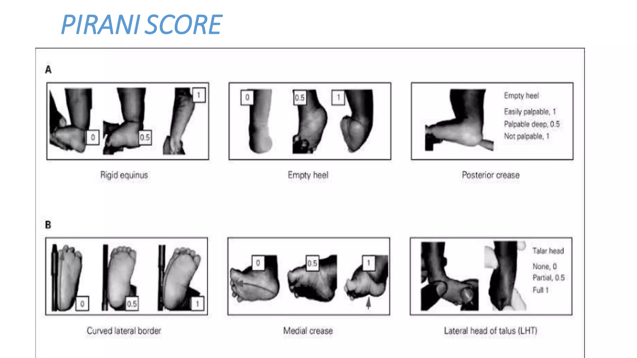 Club foot / CTEV | PDF