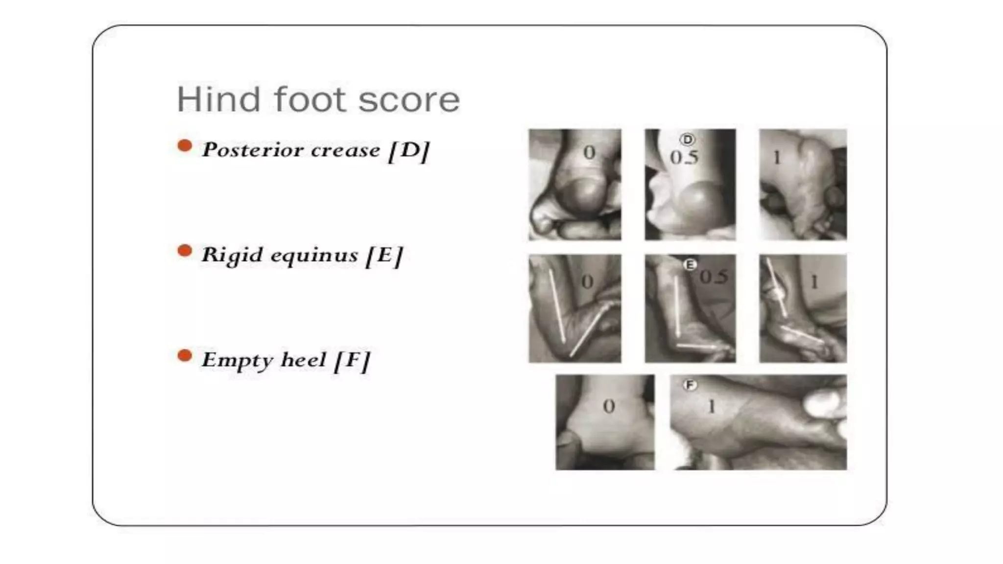Club foot / CTEV | PDF