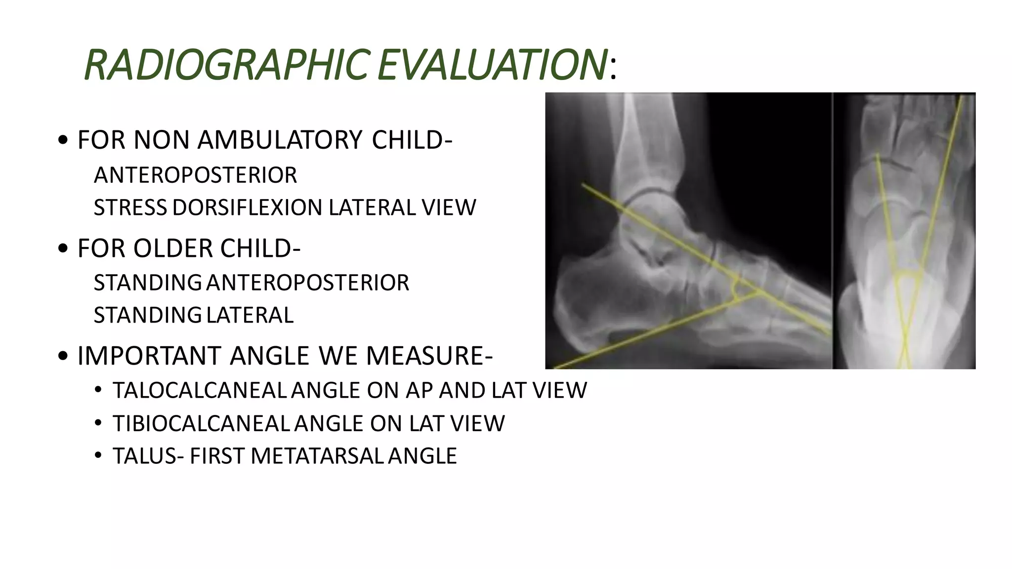 Club foot / CTEV | PDF