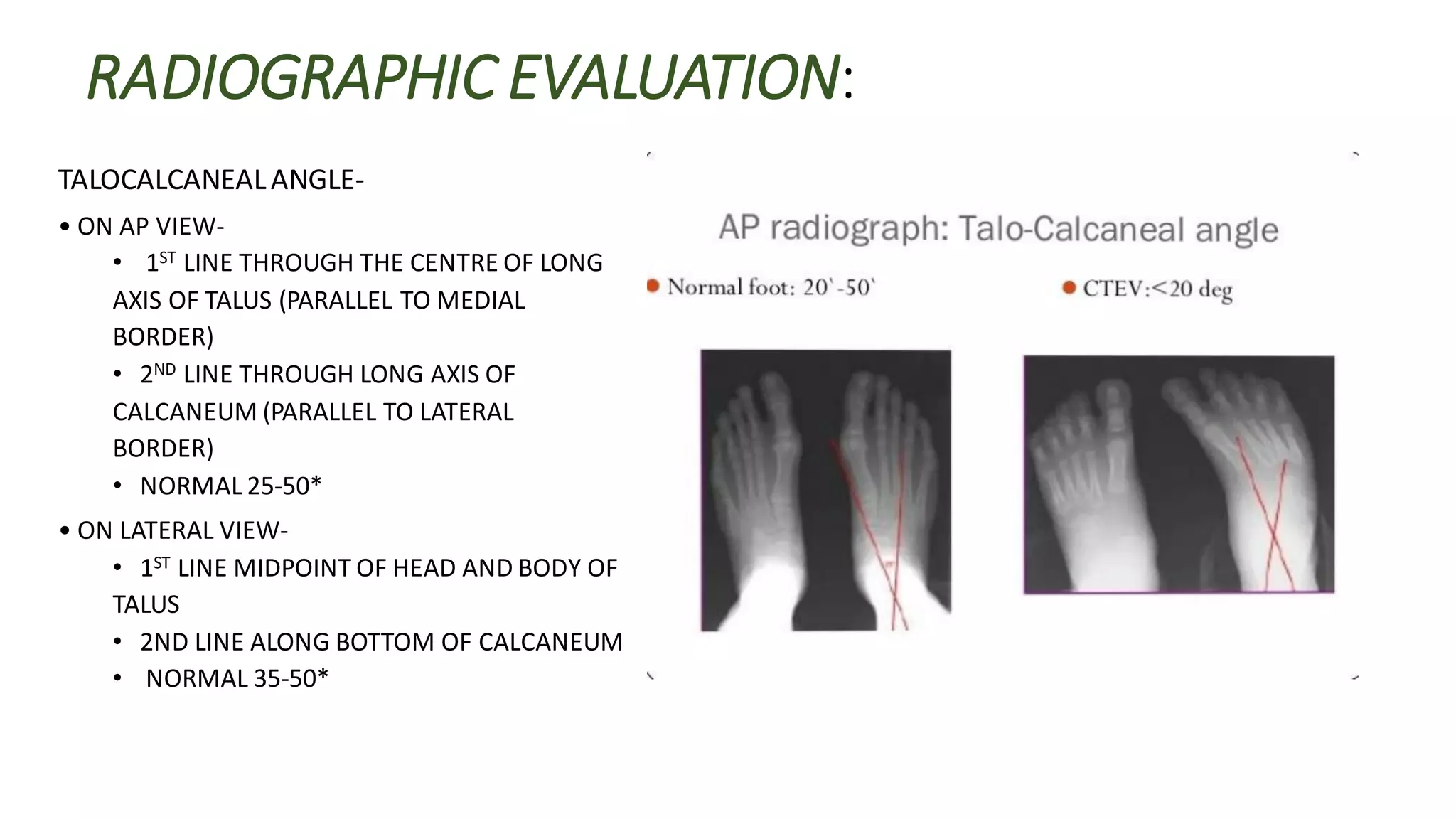 Club foot / CTEV | PDF
