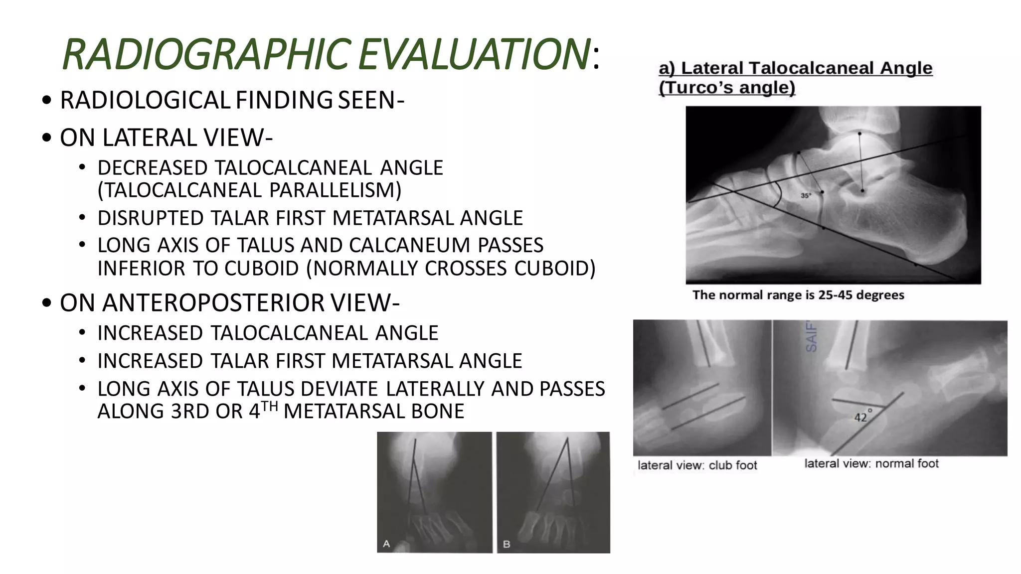 Club foot / CTEV | PDF