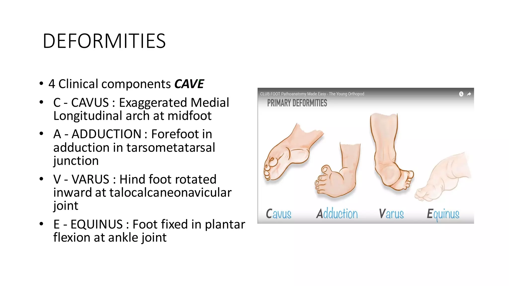 Club foot / CTEV | PDF