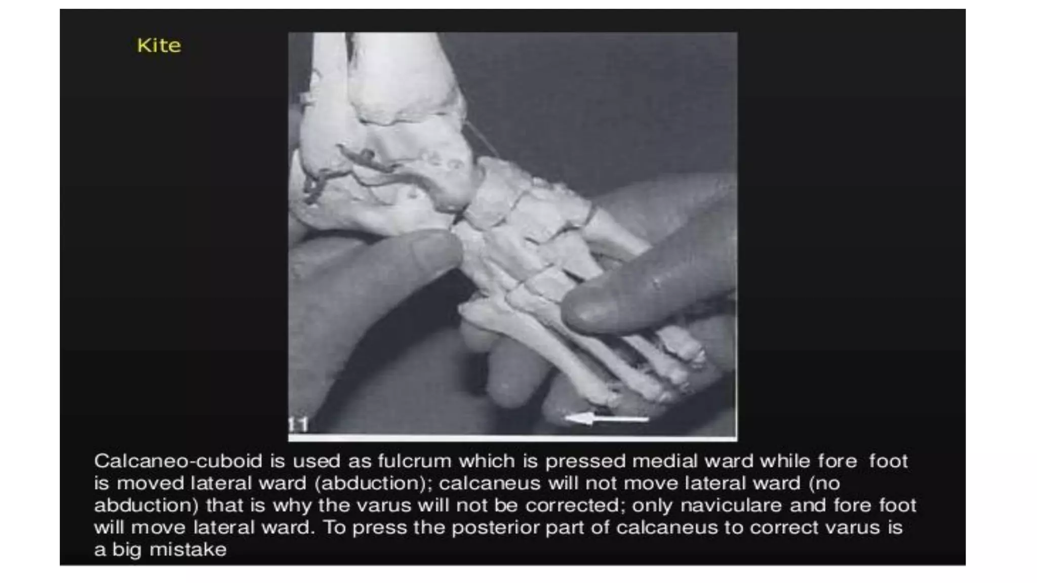 Club foot / CTEV | PDF