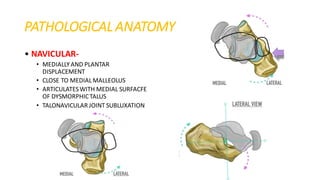 Club foot / CTEV | PDF