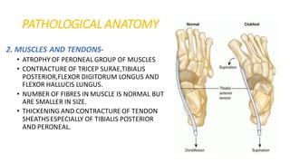Club foot / CTEV | PDF