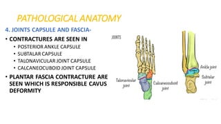 Club foot / CTEV | PDF