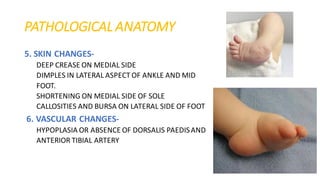 Club foot / CTEV | PDF