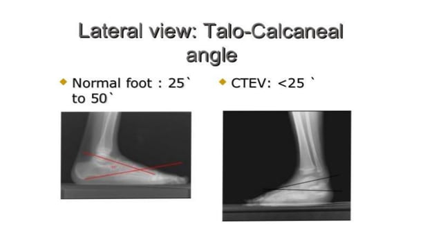 Club foot / CTEV | PDF