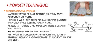 Club foot / CTEV | PDF