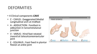 Club foot / CTEV | PPT