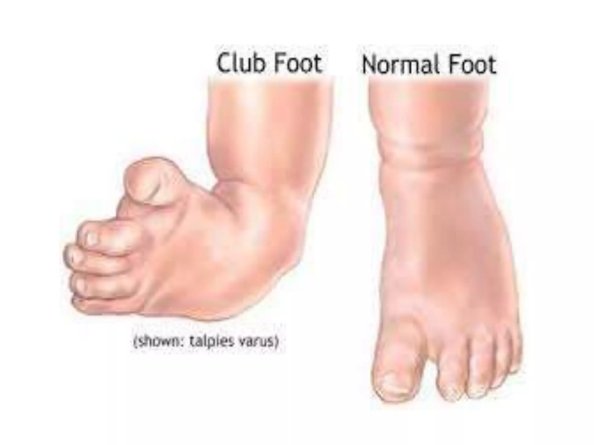 Club foot | PPTX