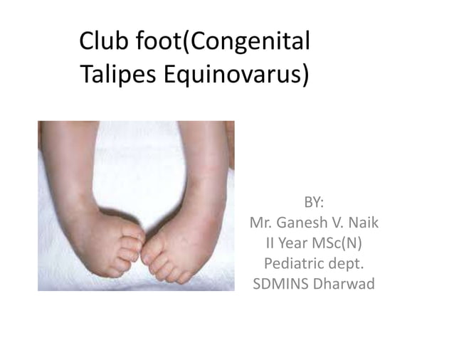 Club foot | PPTX | Pregnancy | Reproductive Health