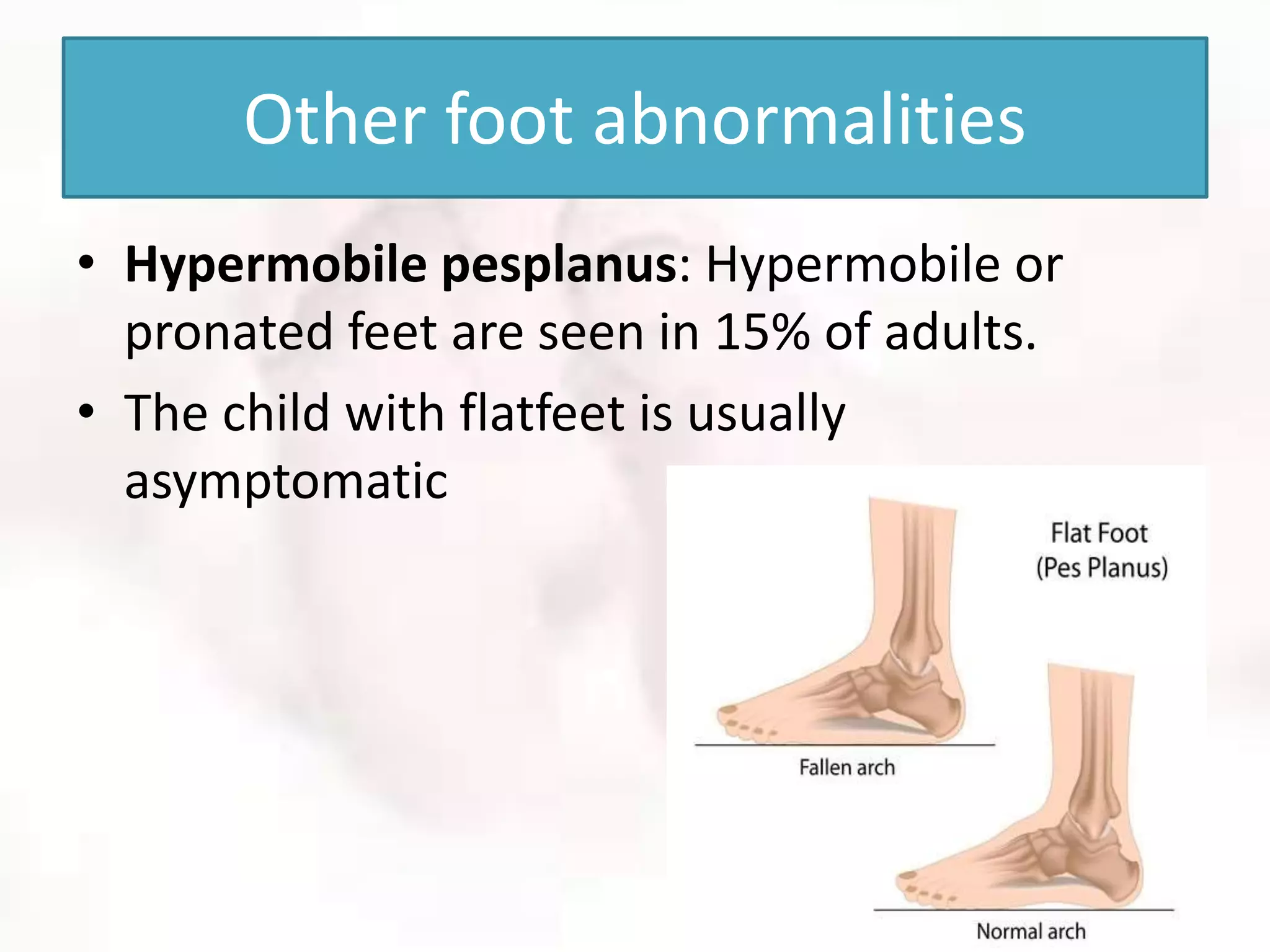 Club foot | PPTX