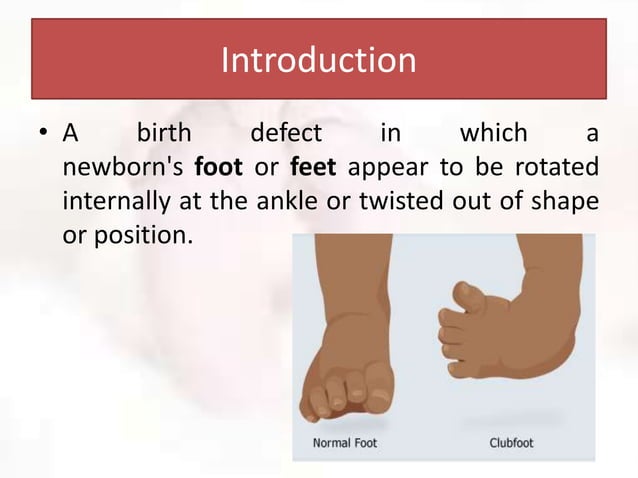 Club foot | PPTX | Death, Injury, or Military Conflict | Sensitive Topics