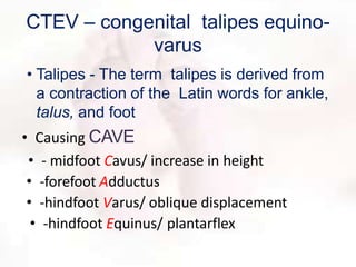 Club foot | PPTX