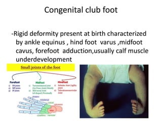 Club foot | PPTX