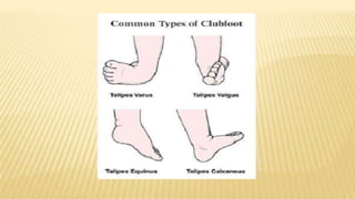 Clubfoot | PPTX