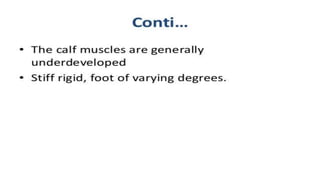 Clubfoot | PPTX