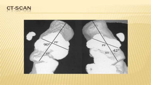 Clubfoot | PPTX