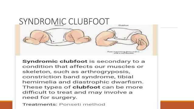 Clubfoot | PPTX