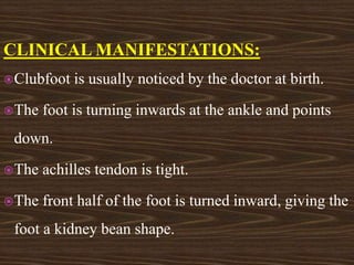 Club foot | PPT