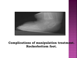 Club foot | PPT