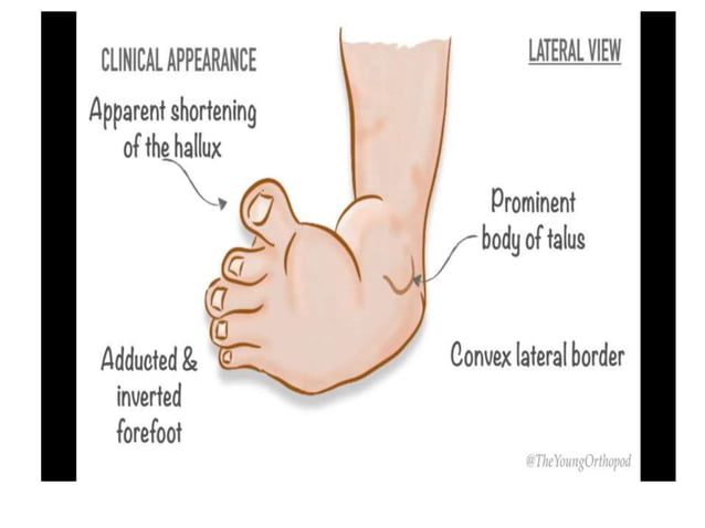 Clubfoot | PPT