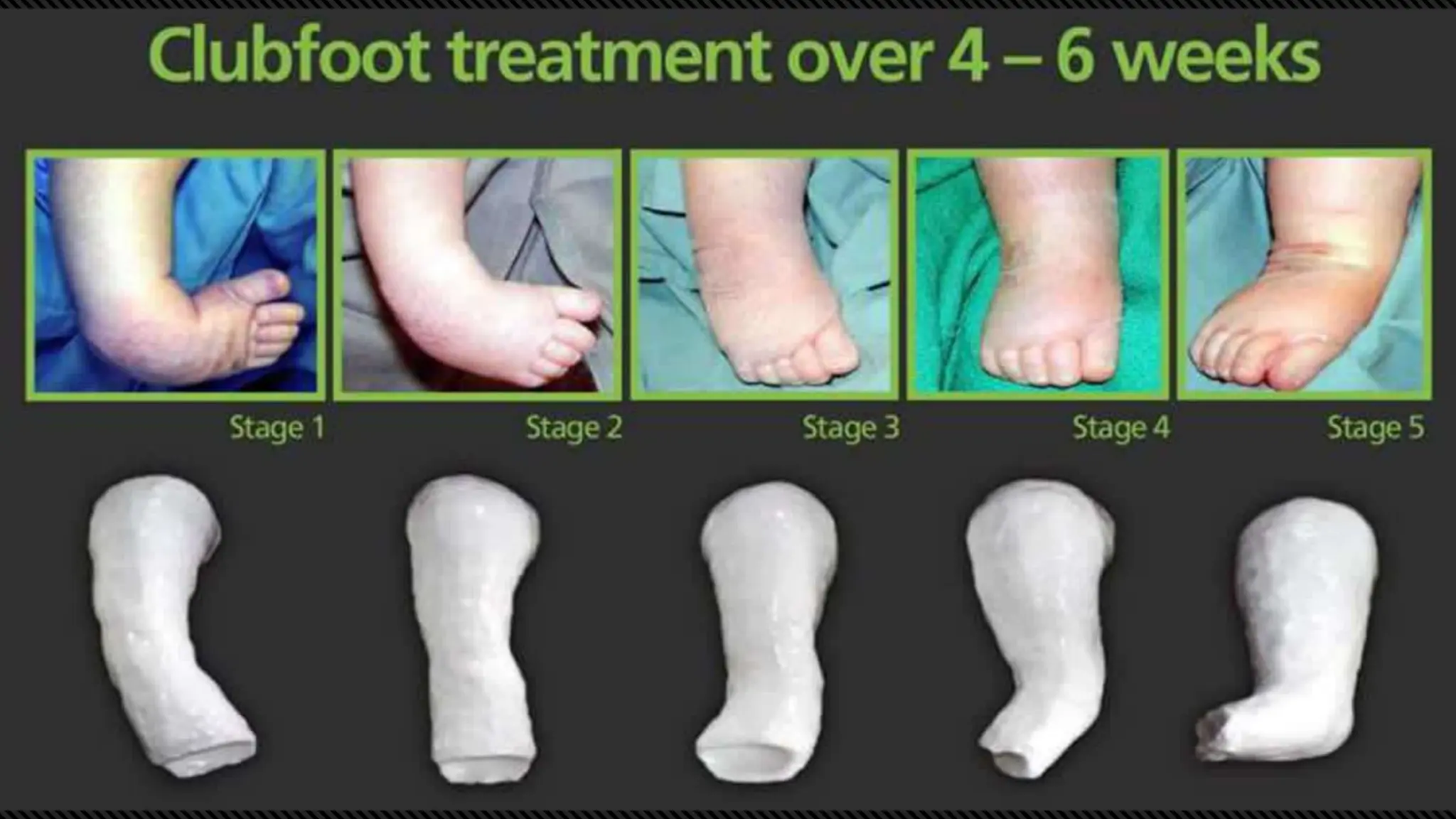 Club foot detailed lecture power point.pptx