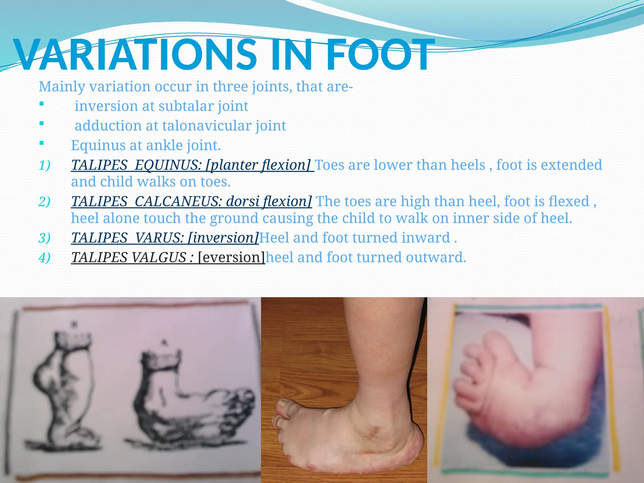 A nice Congenital CLUB FOOT.pptx presentation | PPTX