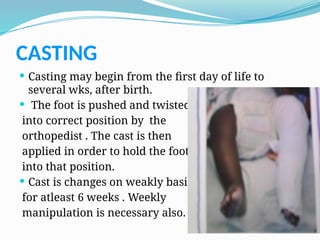 A nice Congenital CLUB FOOT.pptx presentation | PPTX
