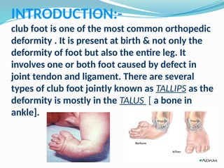 A nice Congenital CLUB FOOT.pptx presentation | PPTX
