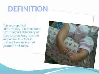 A nice Congenital CLUB FOOT.pptx presentation | PPTX