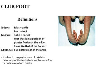 club foot in children, by Dr. Sapna Singh, Professor, Teerthanker ...