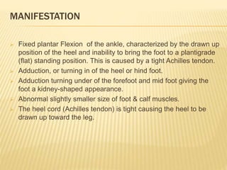 Clubfoot prof g s patnaik | PPTX