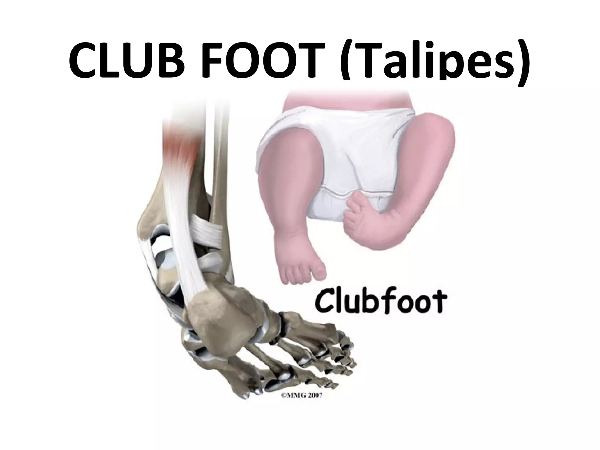 Club foot[1] | PPT