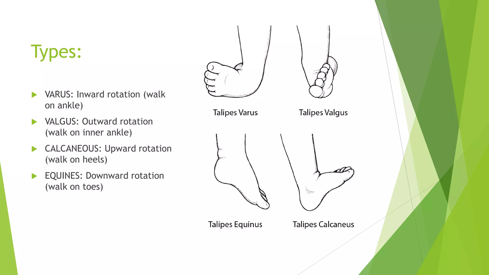 CLUB FOOT 1.pptx