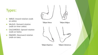 CLUB FOOT 1.pptx
