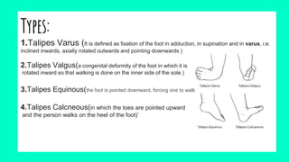 Club foot ppt | PPTX