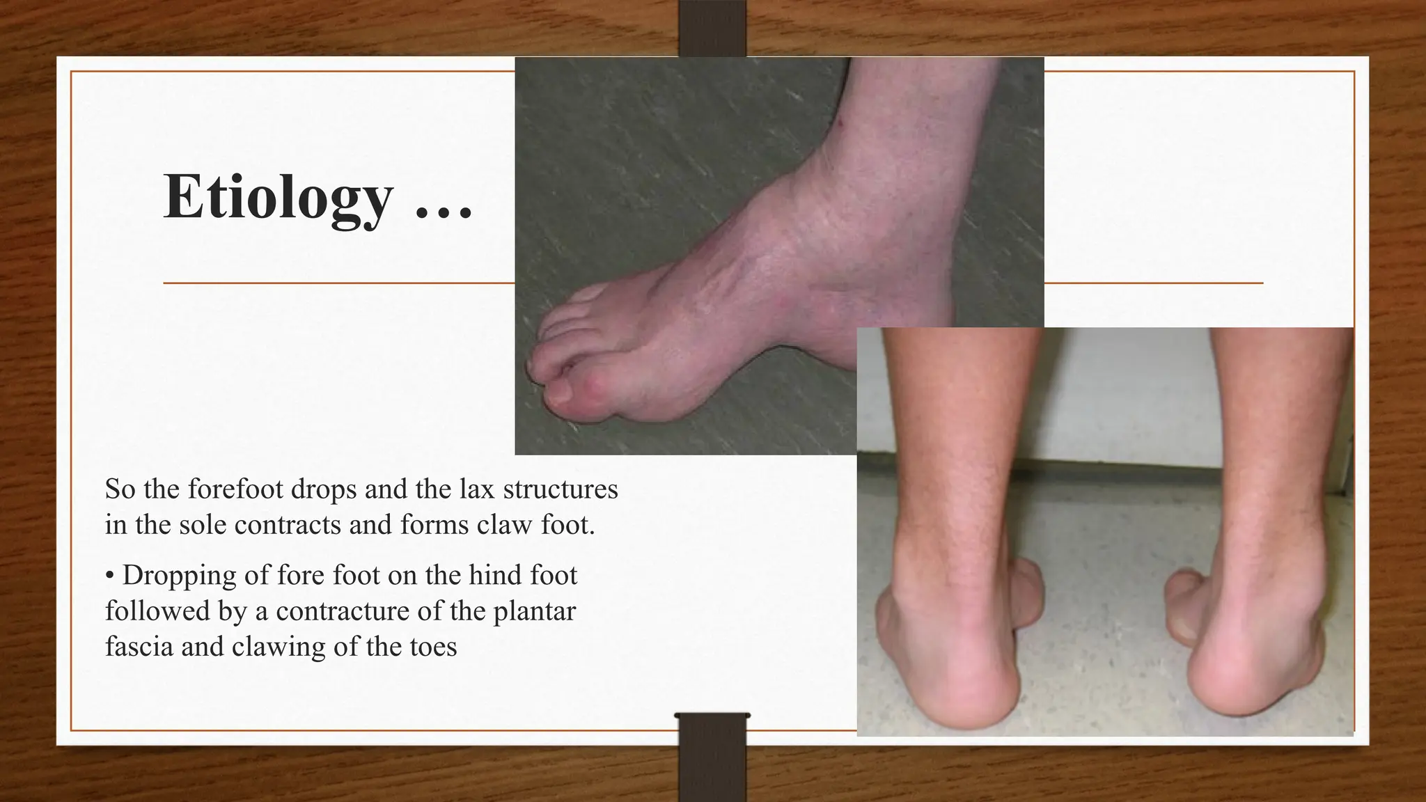 CLUB FOOT (2).pptxnnnnnnnnnnnnnnnnnnnnnnnn | PPTX