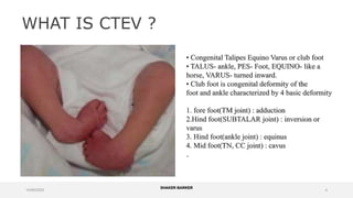 Club foot SHAKER BARKER | PPT