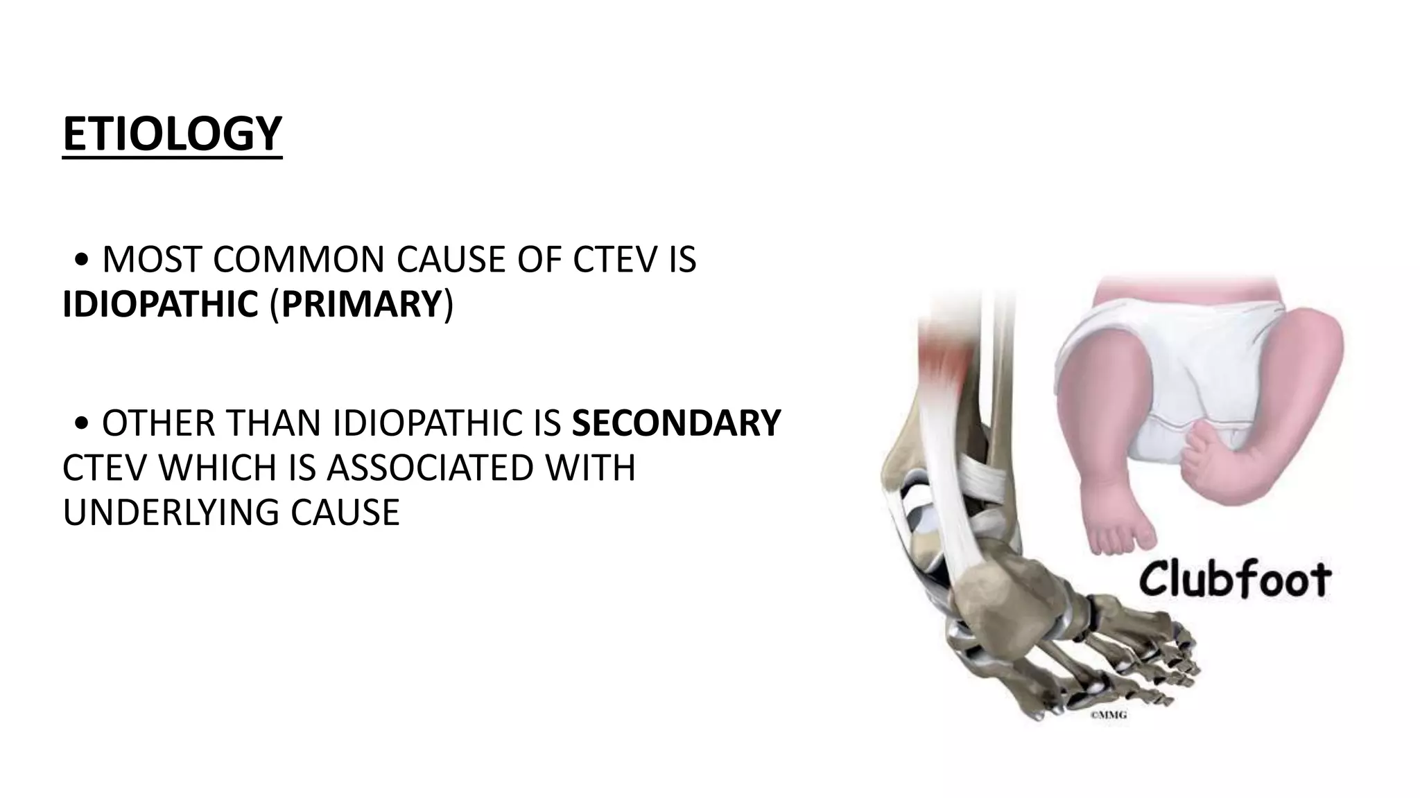 CTEV / Club foot by Dr Baijnath Agrahari | PPT