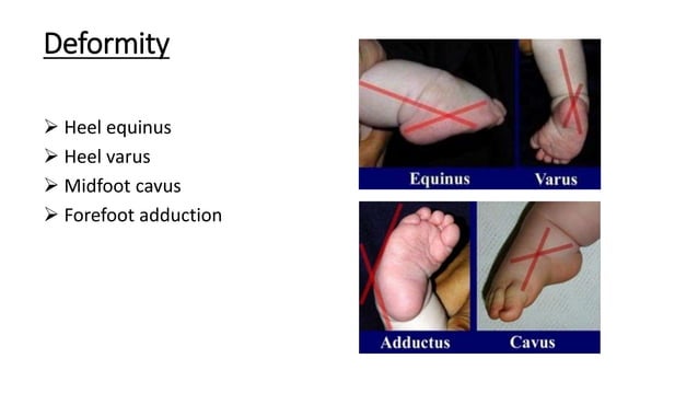 CTEV / Club foot by Dr Baijnath Agrahari | PPT