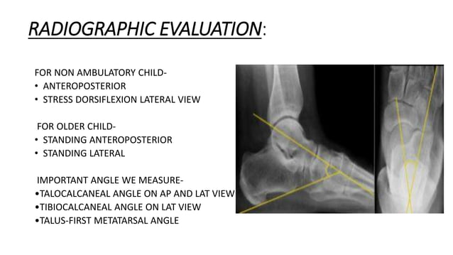 CTEV / Club foot by Dr Baijnath Agrahari | PPT
