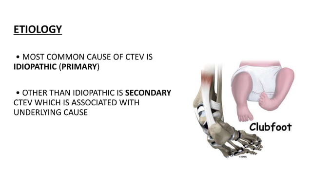 CTEV / Club foot by Dr Baijnath Agrahari | PPT