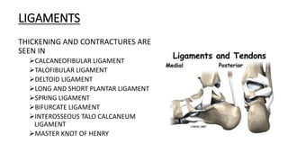 CTEV / Club foot by Dr Baijnath Agrahari | PPT