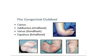 Clubfoot By Prof. Dr. Kamruzzaman sir.pptx