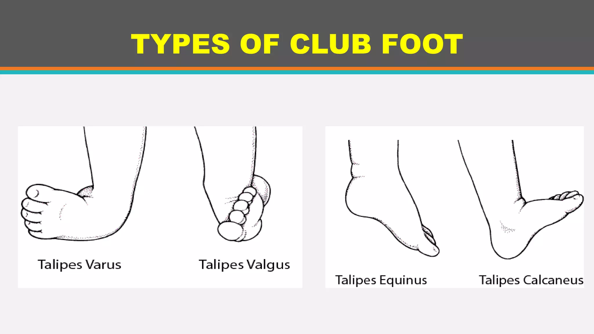 Congenital Club foot-Medical information | PPTX