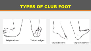 Congenital Club foot-Medical information | PPTX
