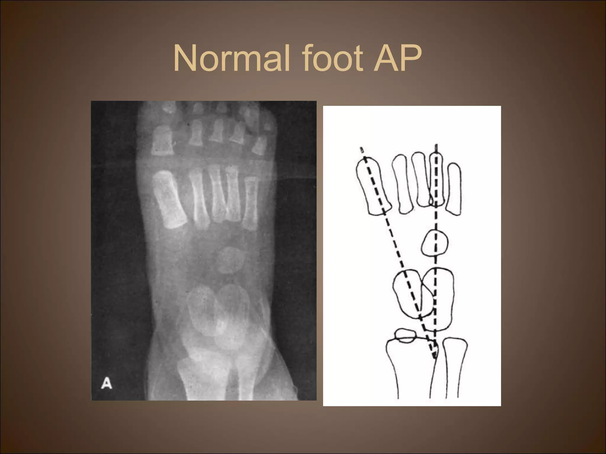 Club foot deformity | PPT